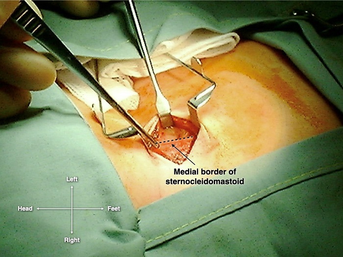 Neonatal venoarterial extracorporeal membrane oxygenation cannulation ...