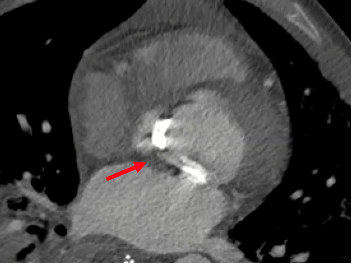 The Commando procedure for mechanical double valve prosthesis ...