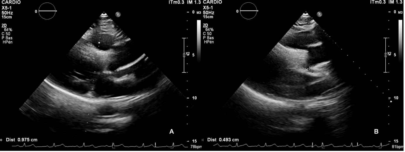 Resection and double pericardial patch repair of a congenital aneurysm ...