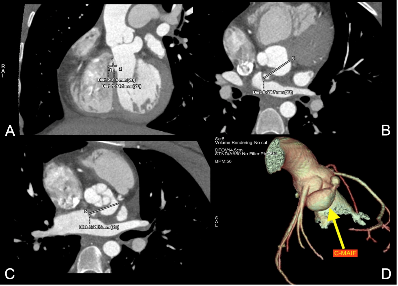 Resection and double pericardial patch repair of a congenital aneurysm ...
