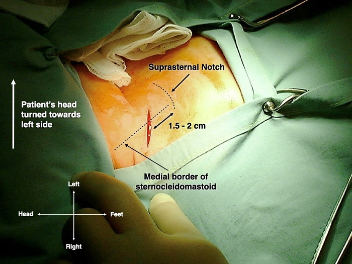 Neonatal venoarterial extracorporeal membrane oxygenation cannulation ...
